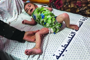 Dangerous skin diseases spreading among Gaza children - Gulf Times
