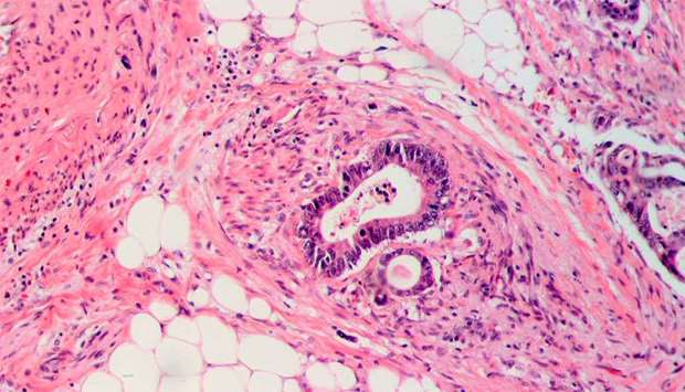 Equalising the fight against cancer - Gulf Times